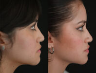 Chin Reduction Beverly Hills, CA & Los Angeles | Dr. Sykes
